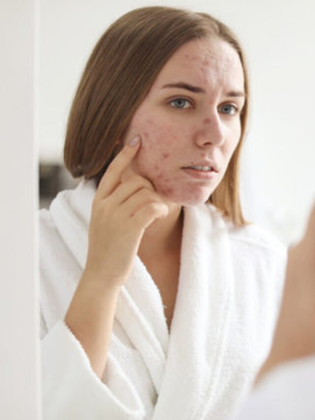 Stop Breakouts Now! Best Ways to Prevent and Treat Acne! - Natureslandingtn